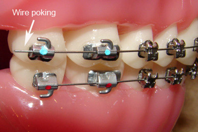 Orthodontic Emergencies Care in Plano | Dr. Goldreich