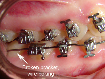 Orthodontic Emergencies Care in Plano | Dr. Goldreich